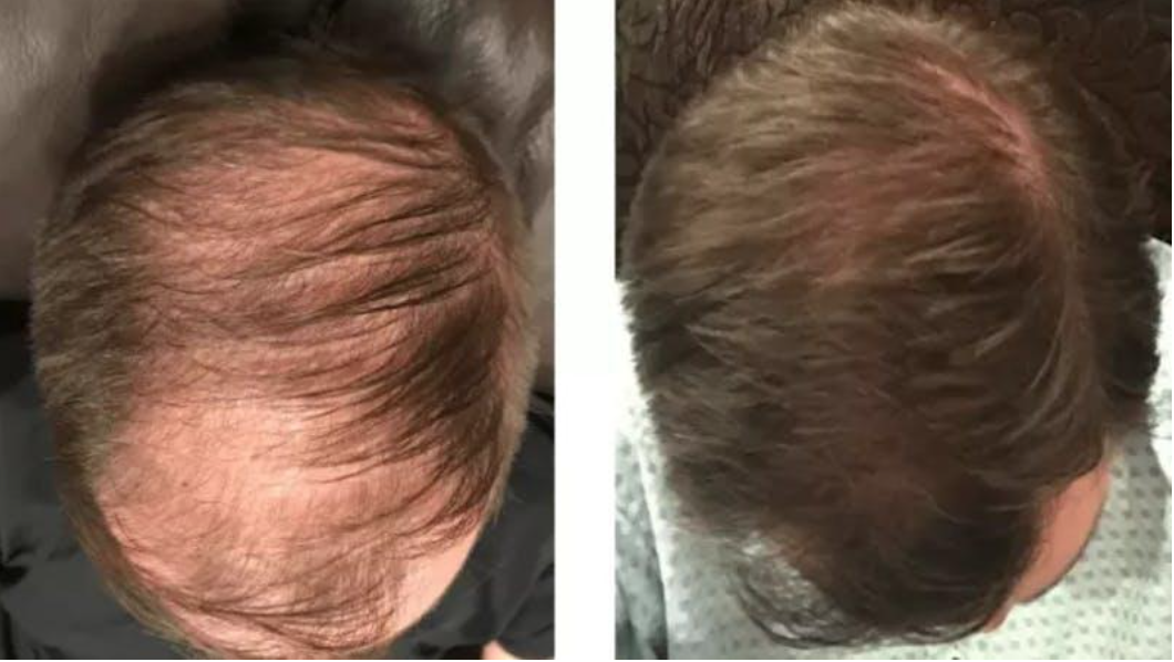 Hair Restoration: Oral & Topical Therapies through Compounding ...