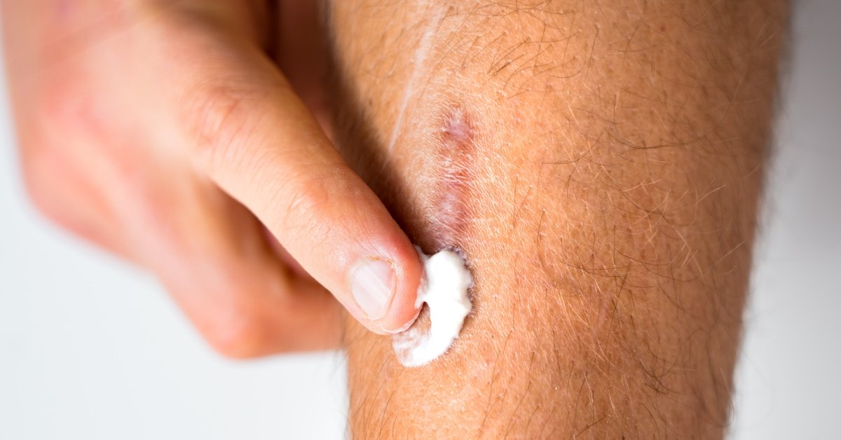 Enhancing Scar Care for Humans and Animals: PCCA’s PracaSil®-Plus Base ...